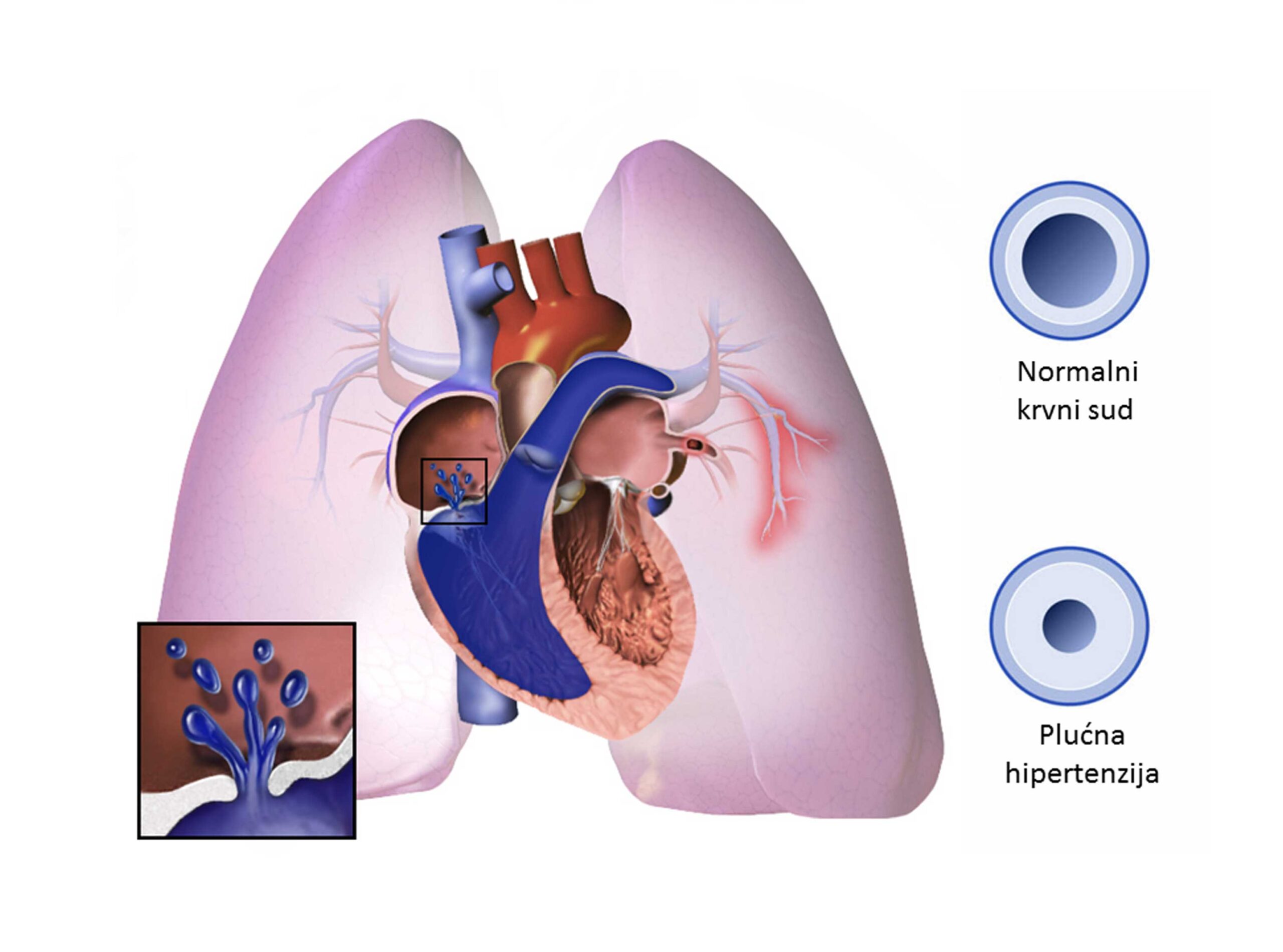 Šta je PAH? - PH Srbija